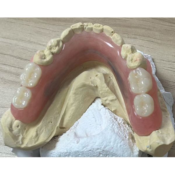 Quality Removable Denture with Lingual Bar Retention for High Precision Fit and for sale