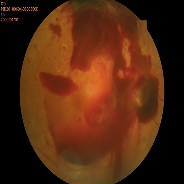Quality High Resolution Automated Fundus Camera with FFA or FAF, mosaic function for sale