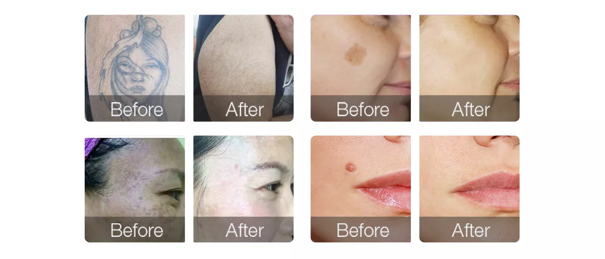 picosecond tattoo removal laser