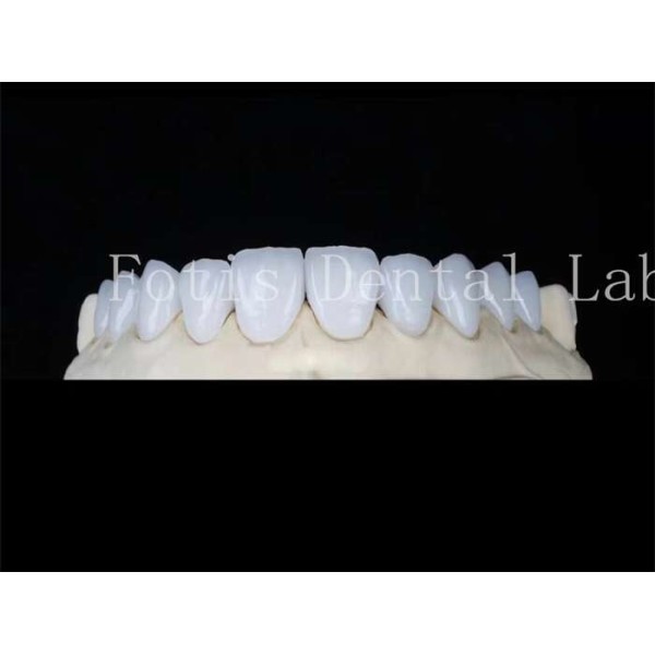 Quality Customized Natural Porcelain Veneers Dental Lab Veneers Stain Resistant for sale